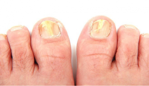 Testing for fungal nails - The Foot Clinic Paignton